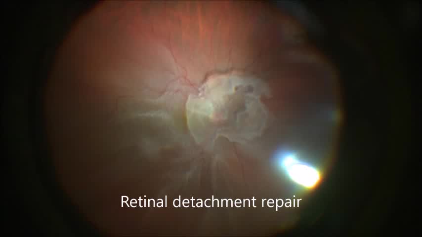 Retinal Detachment and Zonular Dialysis After Blunt Trauma - Eyetube