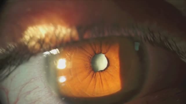 Phakic Black IOL for Leukocoria - Eyetube