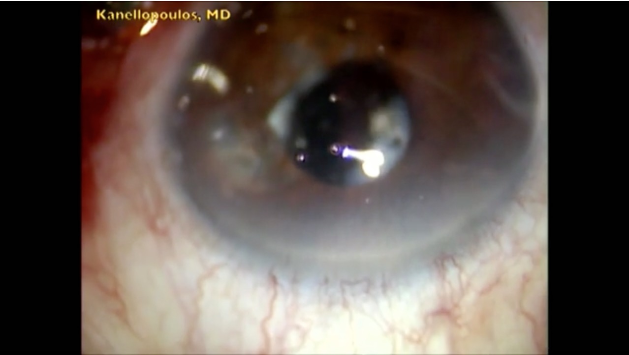 Retained Cortex - Eyetube