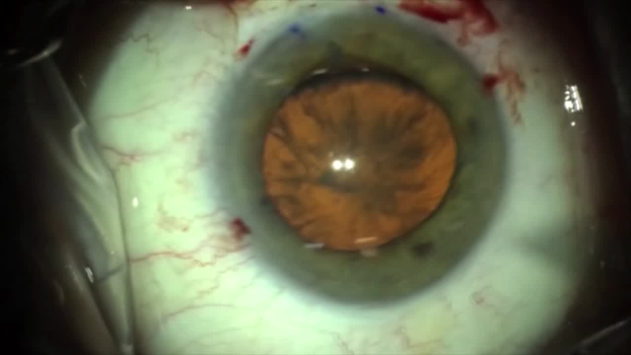 Profound Zonulysis - Eyetube