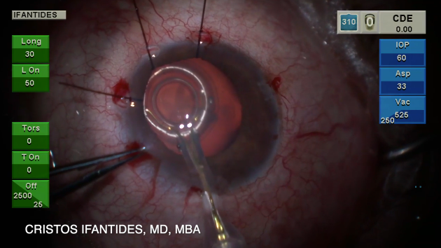 Zepto and Ahmed Segment for Phacodonesis - Eyetube