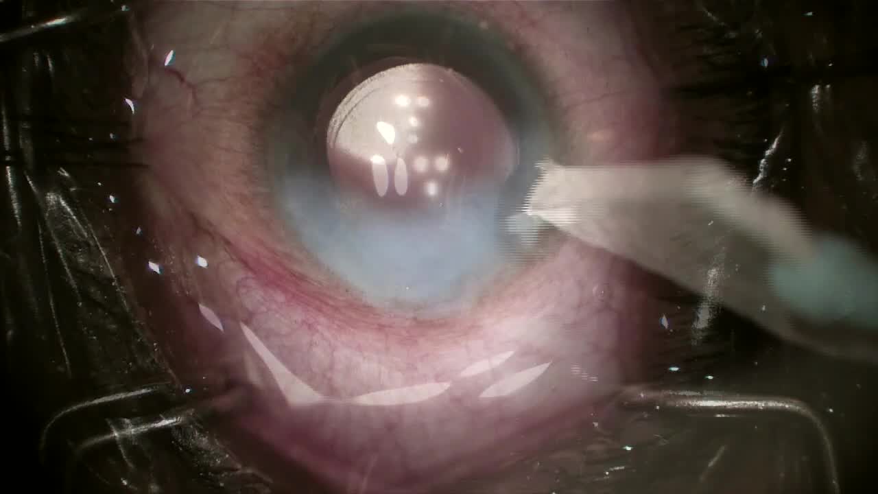 Omni Hydrus: Combination MIGS - Eyetube