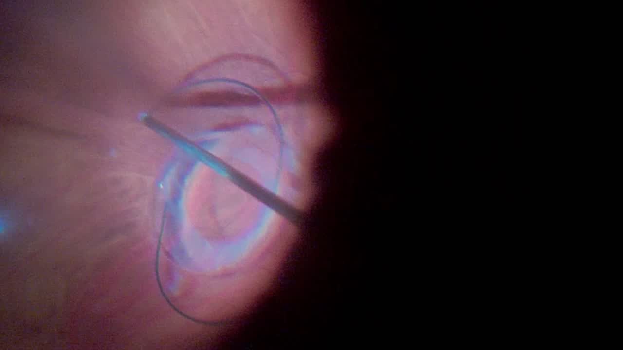 Shaolin Retina Episode I: Yamane-Style IOL Rescue and Refixation - Eyetube