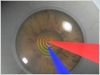 Argon Laser-Iridoplasty to Improve Visual Function Following Multifocal ...