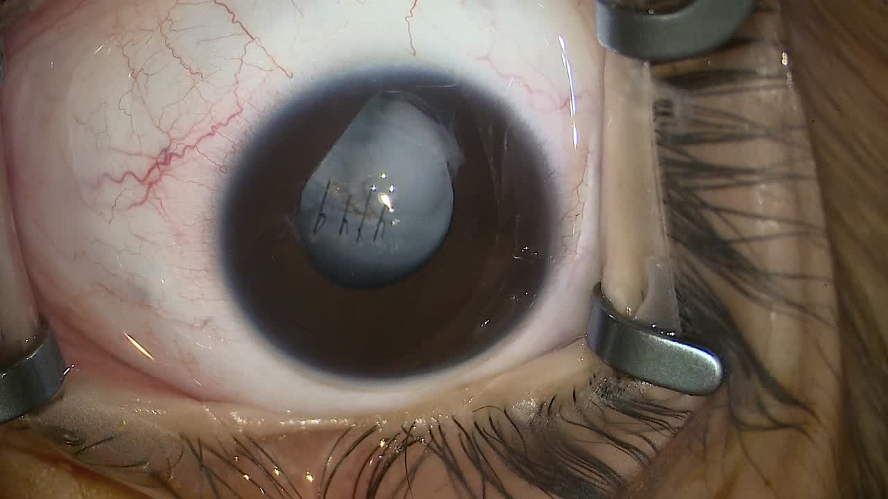Traumatic Cataract after Open Globe Repair - Eyetube