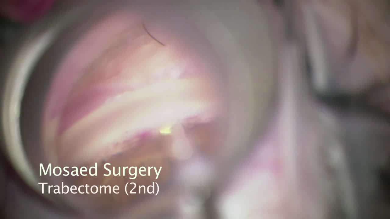 Trabectome Surgery - Eyetube