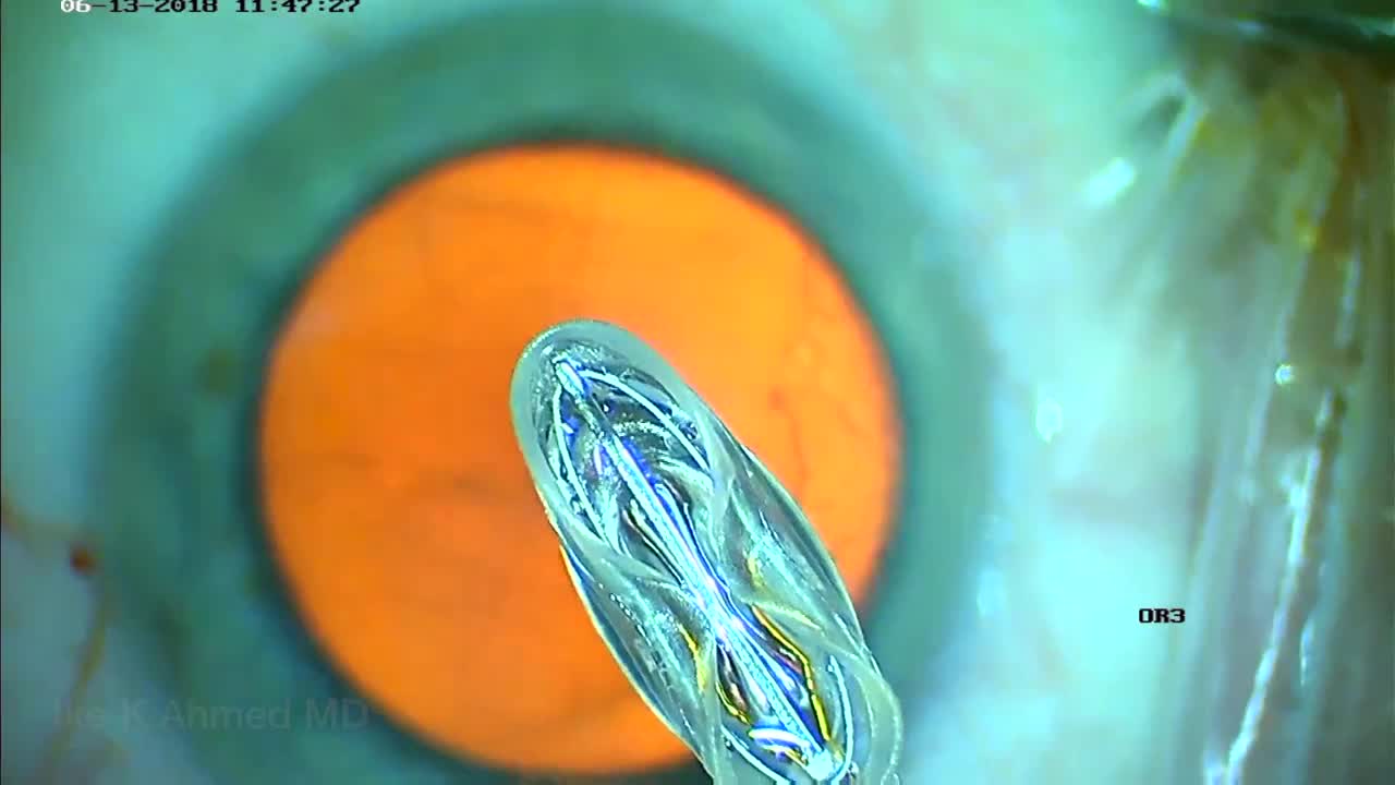 Zepto Precision Pulse Capsulotomy during Cataract Surgery - Eyetube