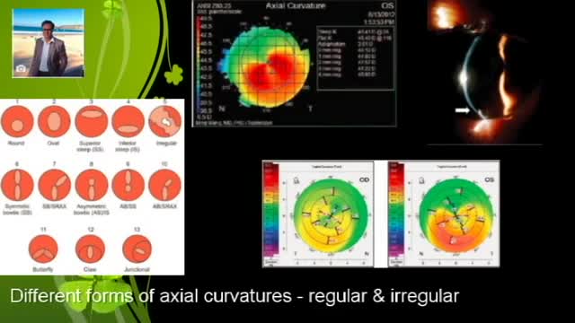 Understanding Corneal Topography and Pentacam - Eyetube