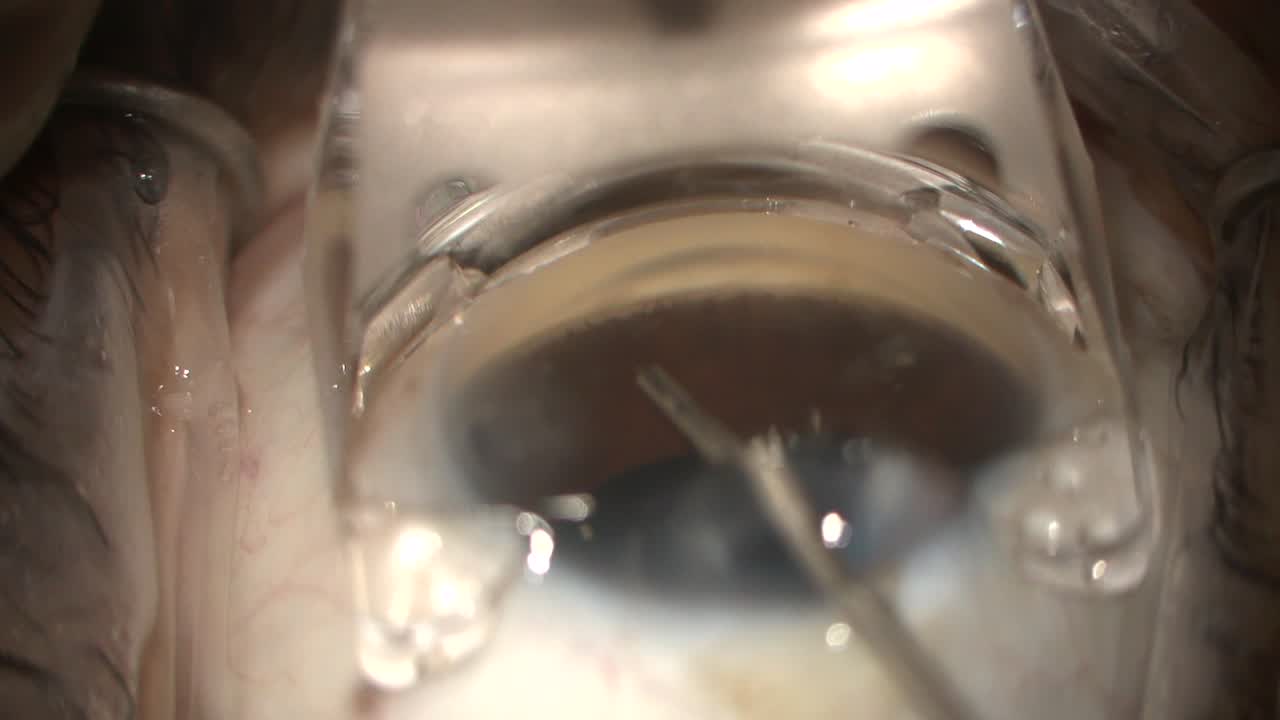 iStent Inject W - Eyetube