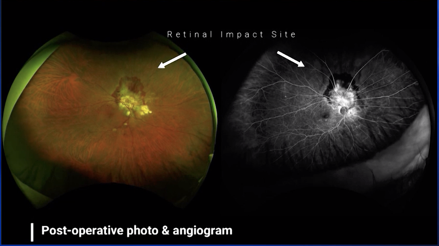 Retinal Impact - Eyetube